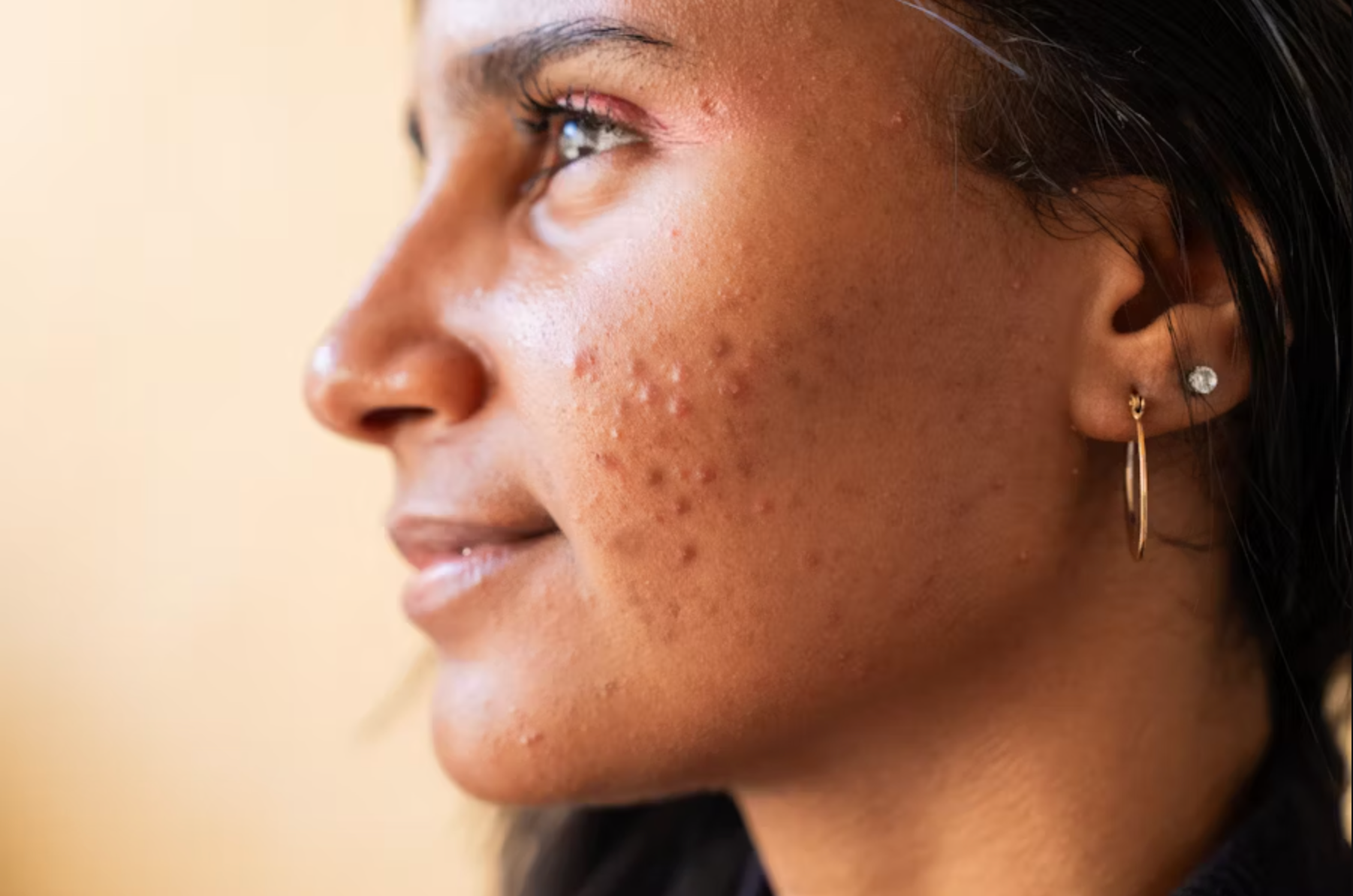 Boutons, kystes et taches : guide complet pour une peau nette – iSeelk